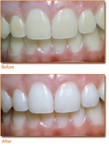 Teeth Whitening Services Dacula, GA - 24HR-TAN